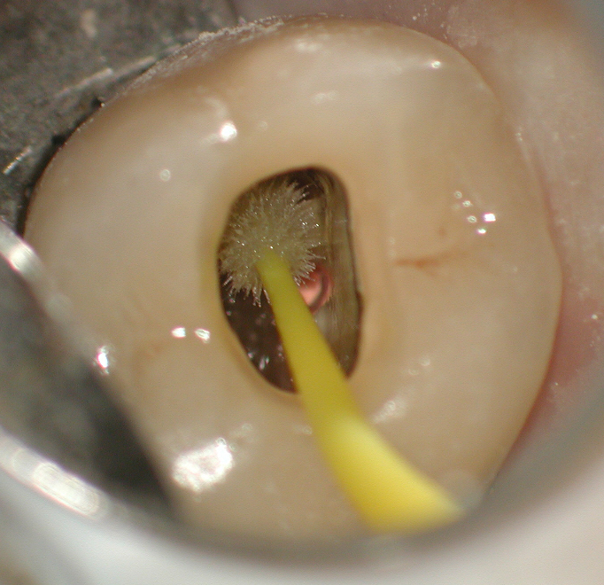 4) dentine primer – Modern Endodontic Care