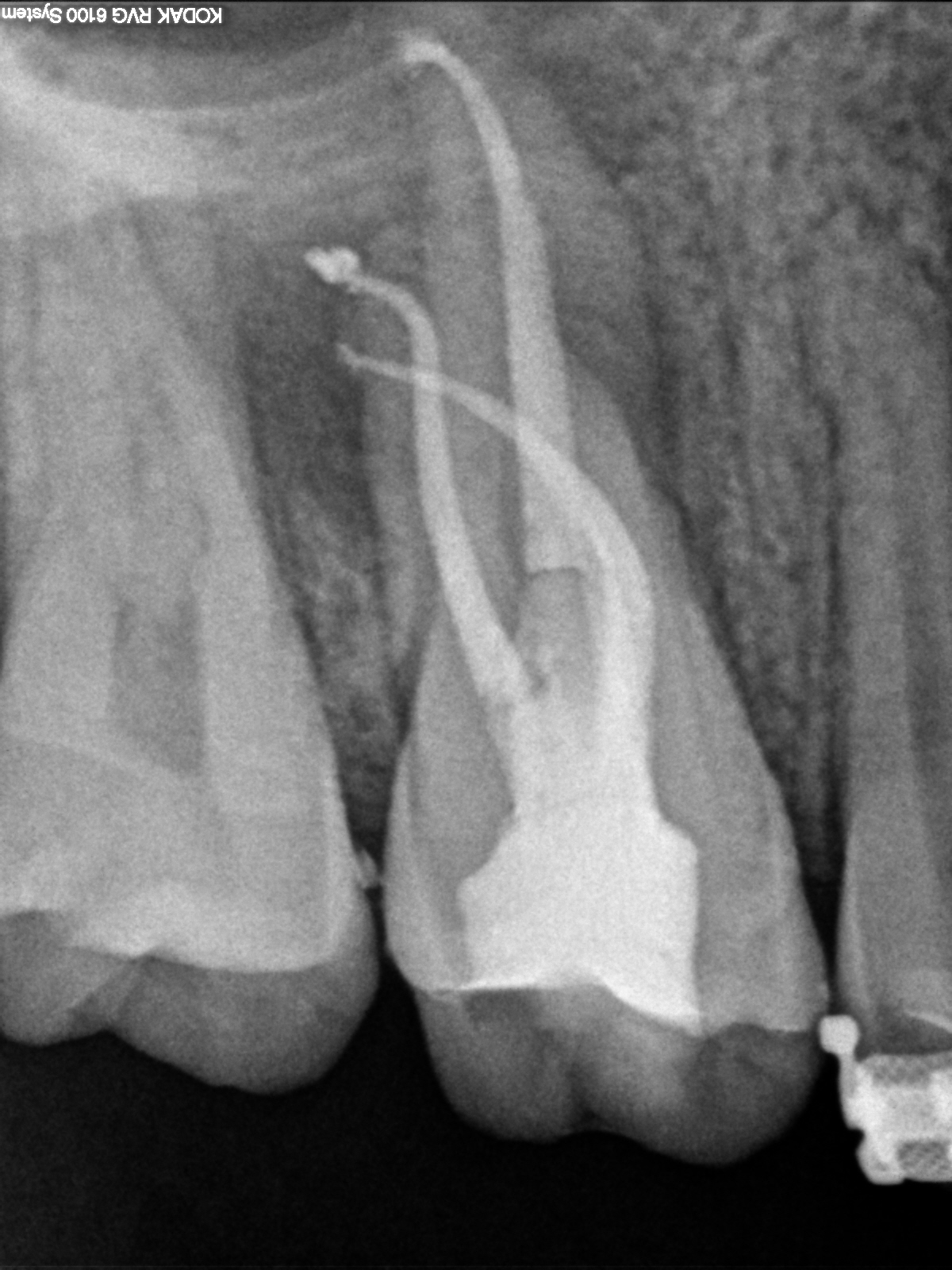 4) post-op – Modern Endodontic Care